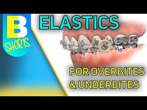 Braces Elastics for Overbite and Underbite #shorts