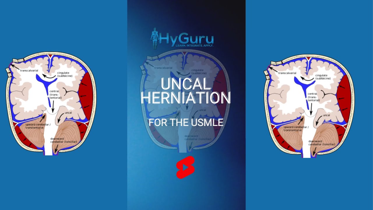Uncal Herniation for the USMLE | HyGuru