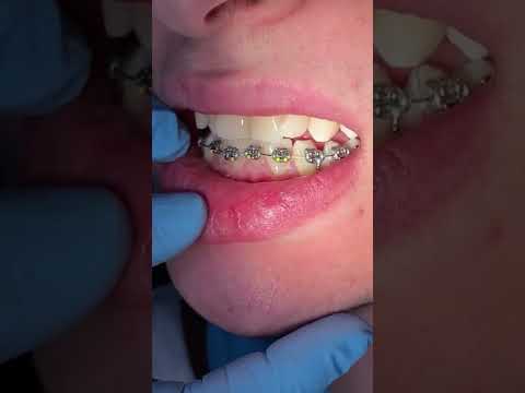 Can I have braces and clear aligners at the same time? Hybrid Orthodontic therapy - Tooth Time