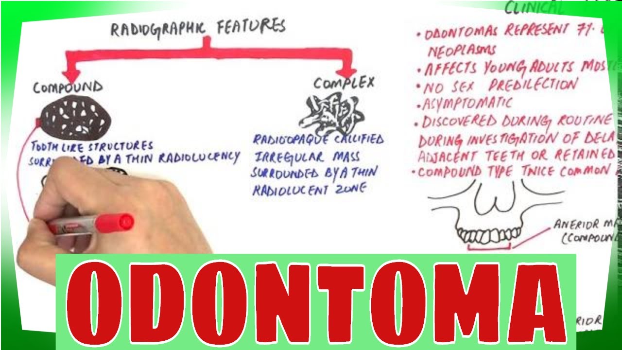 Odontoma - Types, Clinical features, Histopathological Features & Treatment