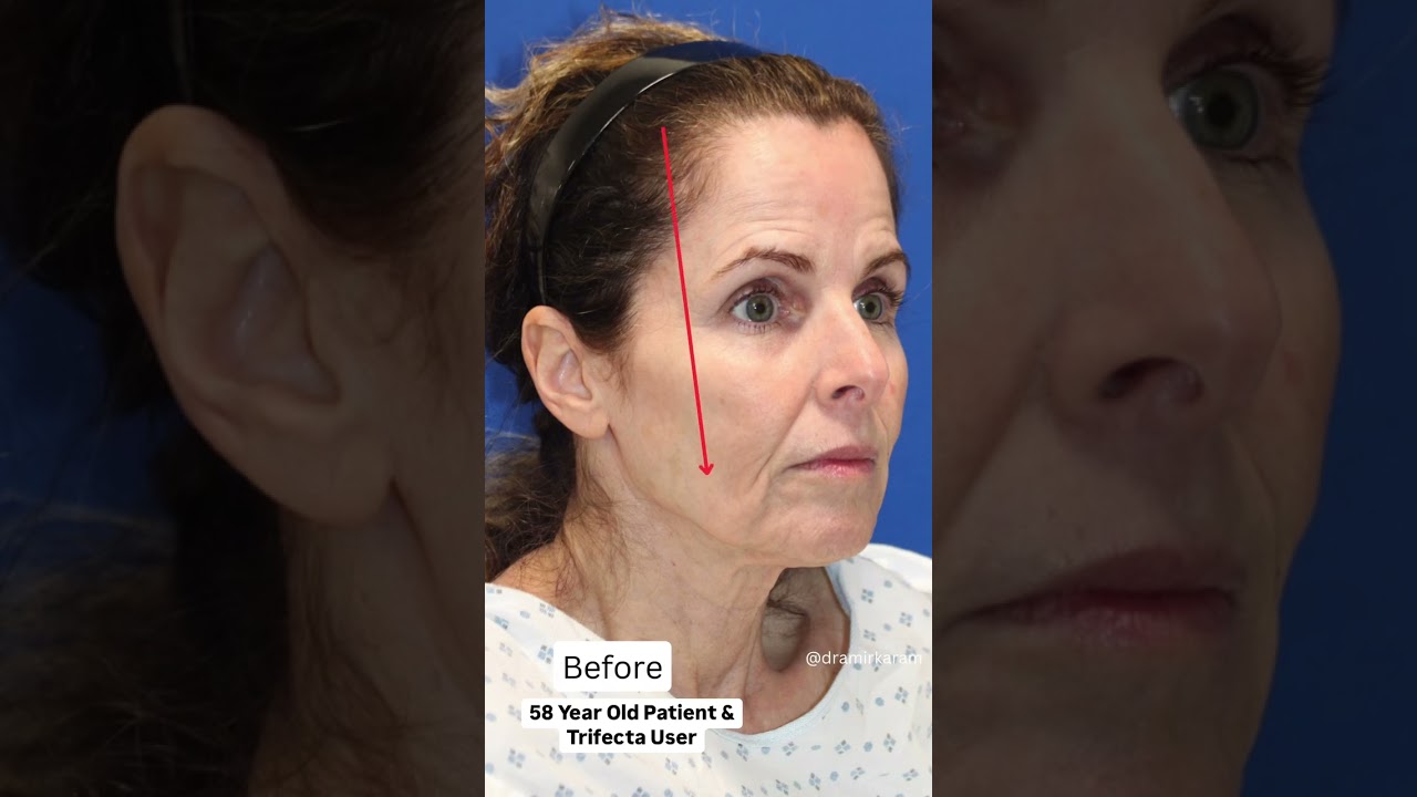 58 Year Old LOOKS 20 YEARS YOUNGER! Facelift Before & After!