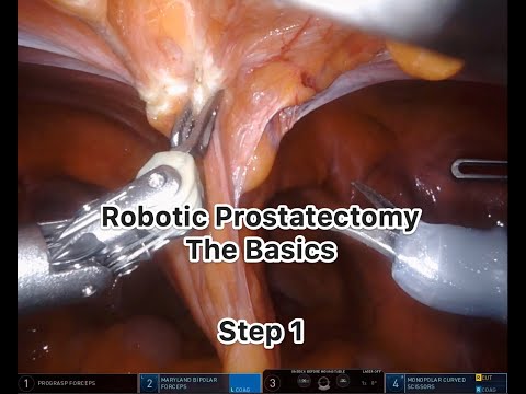 Mastering Robotic Prostatectomy: Here's How I Do It!