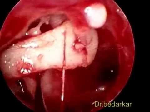 ENDOSCOPIC CARTILAGE TYMPANOPLASTY WITH OSSICULOPLASTY