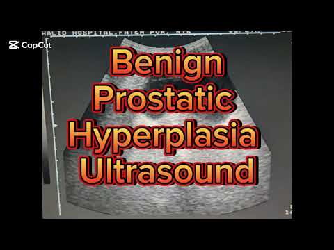 How to Ultrasound Prostate | Benign Prostatic Hyperplasia | Enlarged Prostate | Prostate Volume