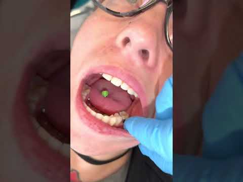 What is it like to have bands fitted for your braces? It's easy and doesn't even hurt.