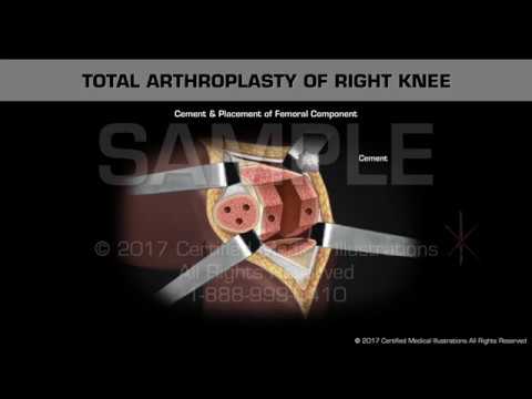 Total Arthroplasty of Right Knee