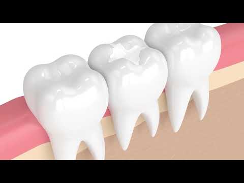 Dental Sealants