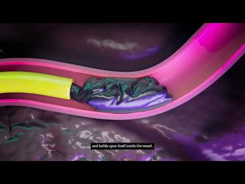 How Obsidio™ Conformable Embolic achieves complete and rapid occlusion