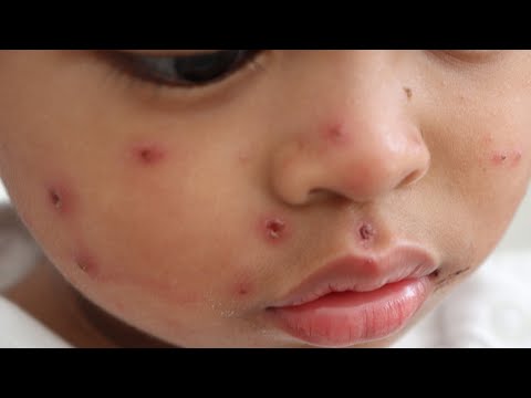 Case of German measles confirmed in San Antonio area school