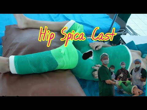 Hip spica cast in OR
