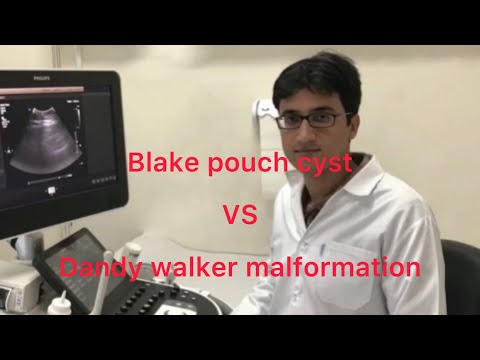 Sonography/ Blake’s pouch cyst and dandy walker malformation