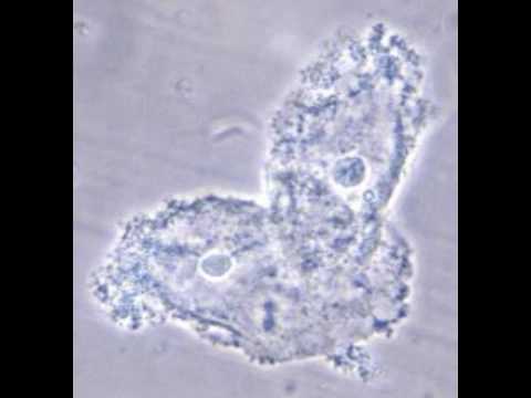10: Bacterial Vaginosis