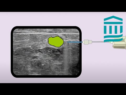 What to Expect During an Ultrasound Breast Biopsy