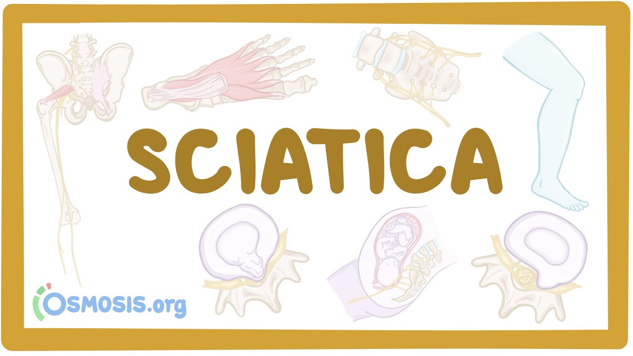 Sciatica - causes, symptoms, diagnosis, treatment, pathology