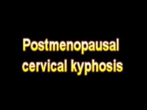 What Is The Definition Of Postmenopausal cervical kyphosis Medical School Terminology Dictionary