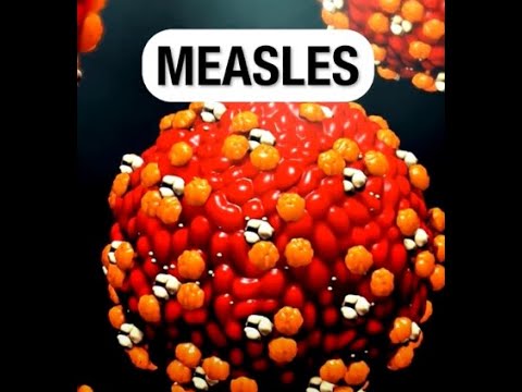 What to know about the measles