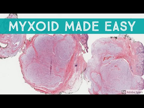 Superficial Angiomyxoma (Cutaneous Myxoma) & Other Cutaneous Myxoid Lesions Made Easy