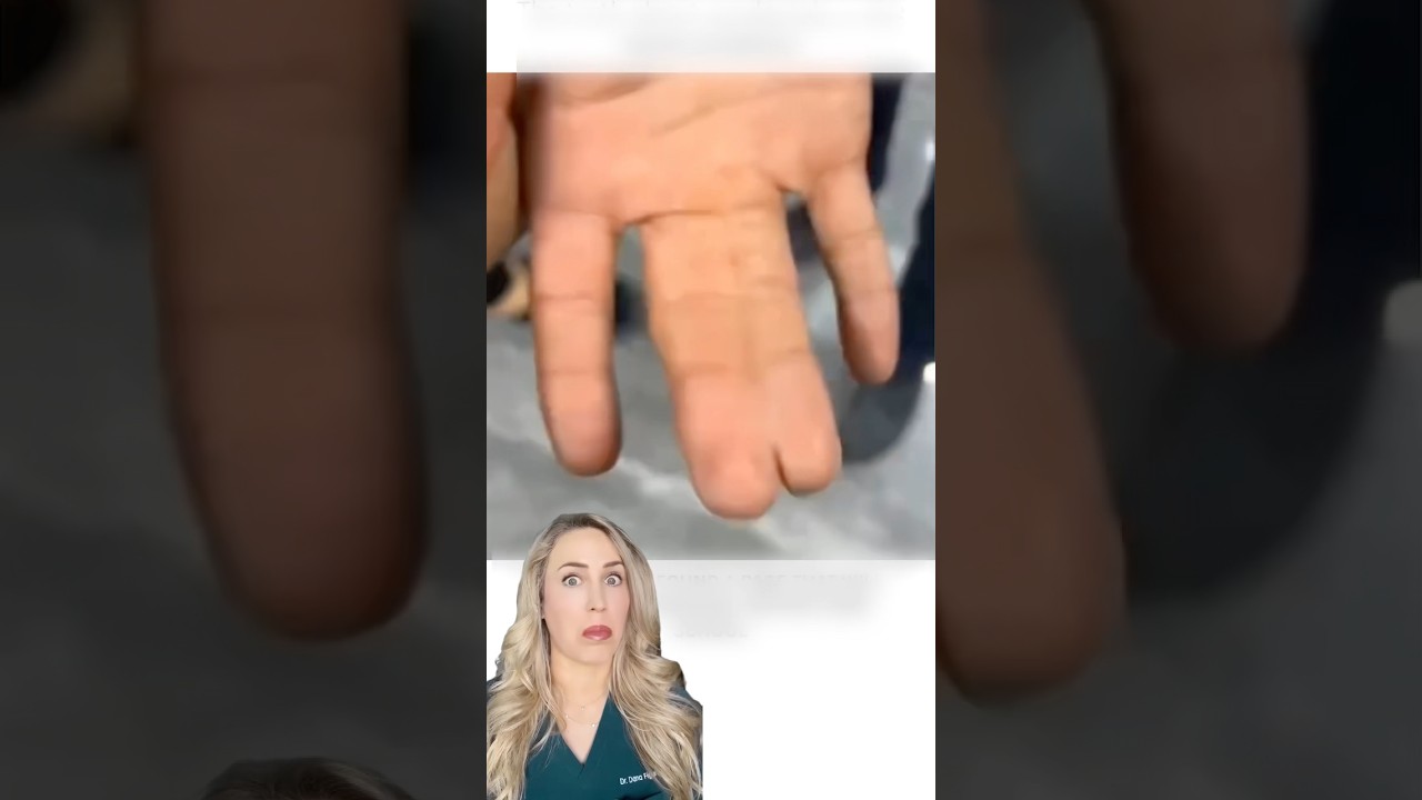 Doctor explains: webbed fingers?!
