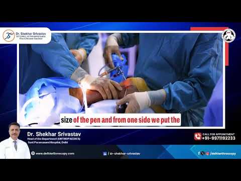 How Long does it take to fully recover from arthroscopy surgery?