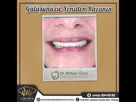Crown Dental TR - Dt. Birkan Önal