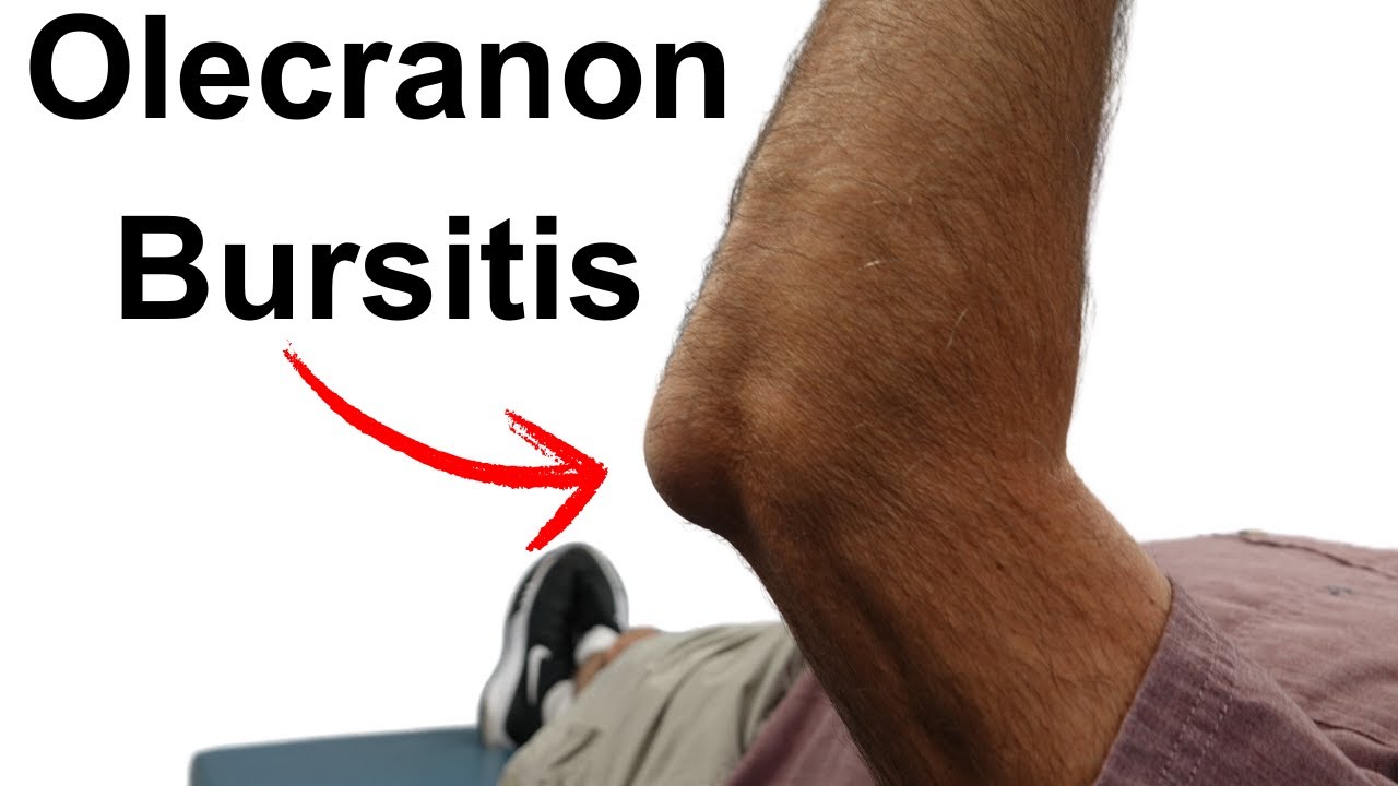 Olecranon Bursitis