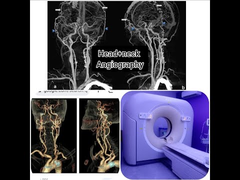 CT Head+ neck Angiography with bolus track