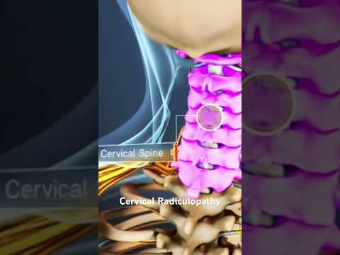 Cervical Radiculopathy