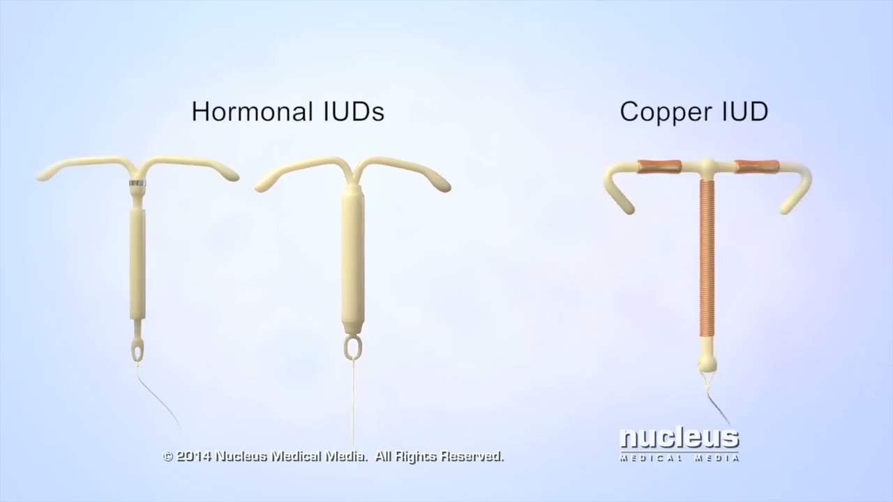 What is an IUD?