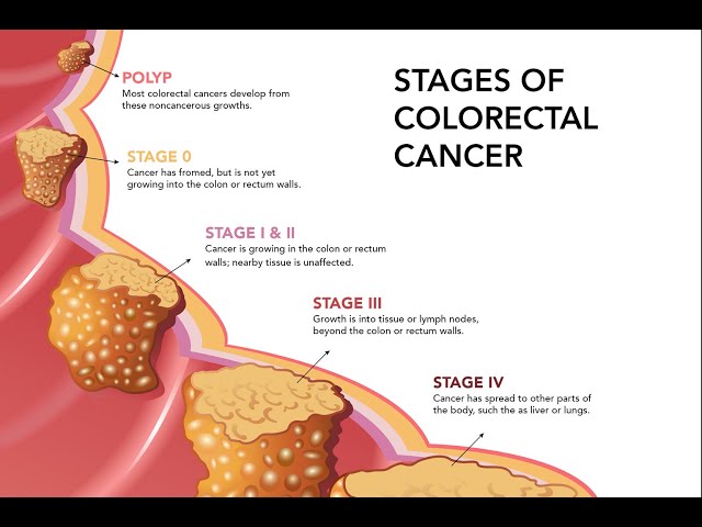 How to pronounce lonsurf | HowToPronounce.com