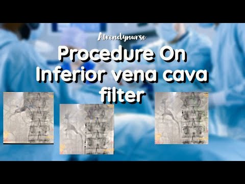 #IVC Filter #Inferior vena cava filter #interventional radiologists