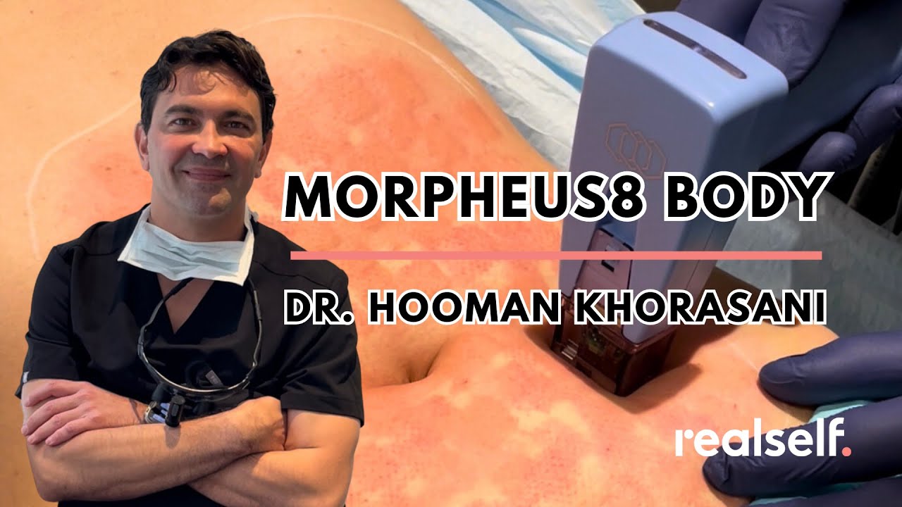 What is Morpheus8? A Dermatologic Surgeon Explains