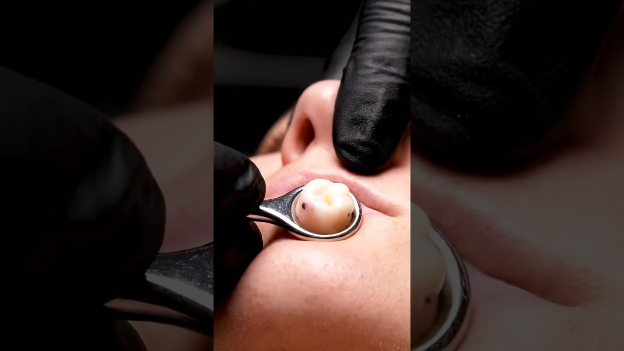 Blackhead Removal #asmr #satisfying #calm #pimple #blackheads #extraction #piercing #skincare