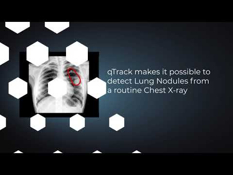 qTrack Nodule - with Astrazeneca and The Lung Health Ambition Alliance