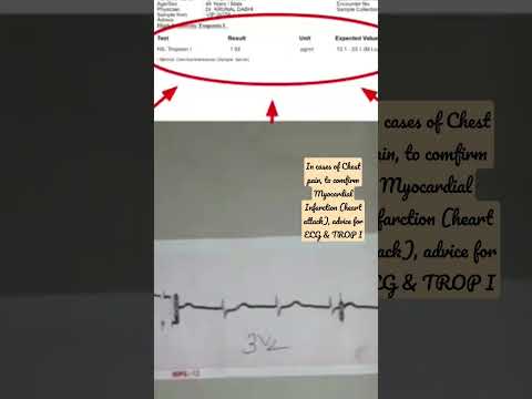 Chest Pain | Advice: ECG & TROP I to comfirm Heart Attack(Myocardial Infarction) I #ecg #heartattack