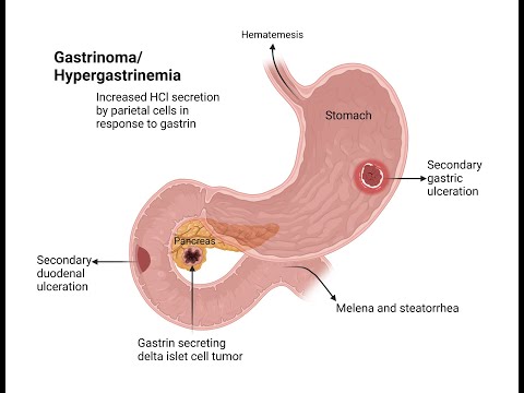 Gastrinoma / Hypergastrinemia ; Definition, Types, Clinical presentation, Diagnosis, Treatment