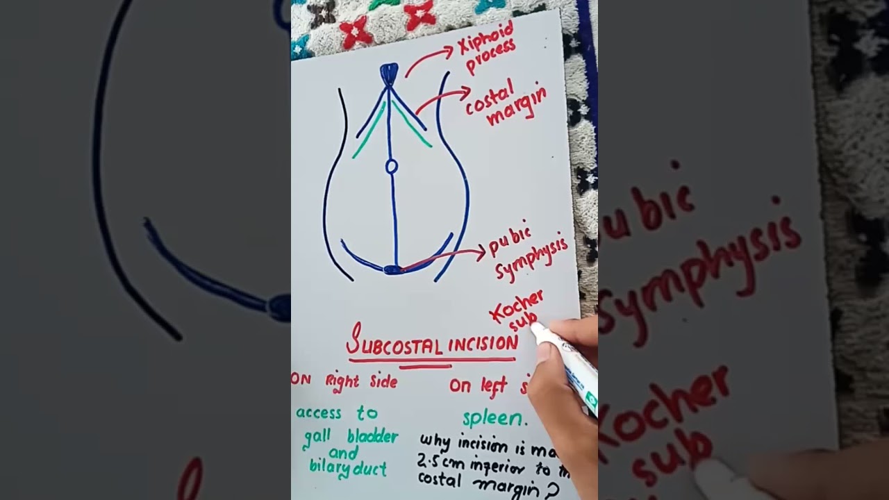 #Subcostal#Incision abdominal incisions