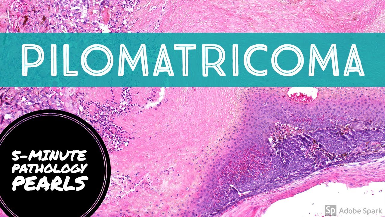Pilomatricoma: 5-Minute Pathology Pearls