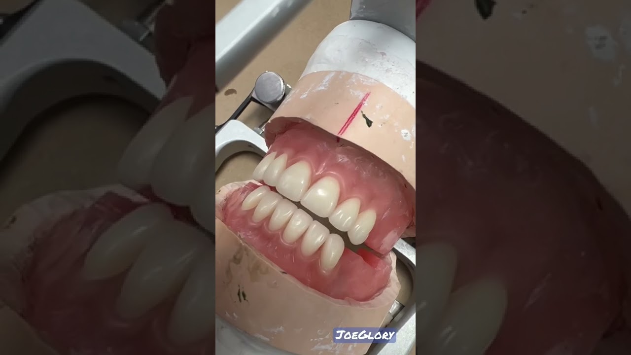 Full dentures Anterior wax set up