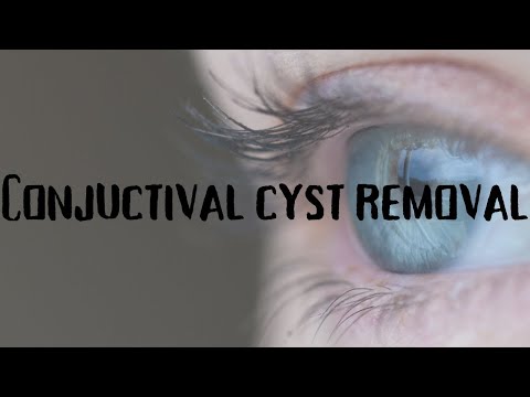 Conjunctival cyst removal