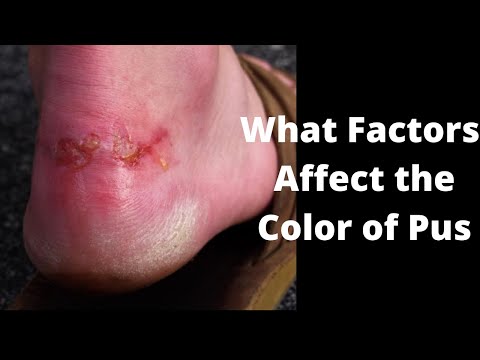 What Factors Affect the Color of Pus