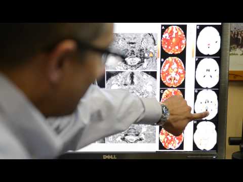 New imaging research shows increased iron in the brain in earliest stages of MS