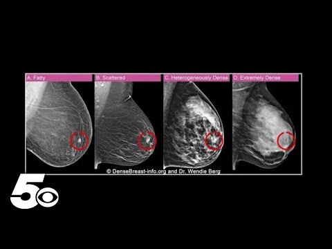 How dense breasts can be a higher cancer risk for women