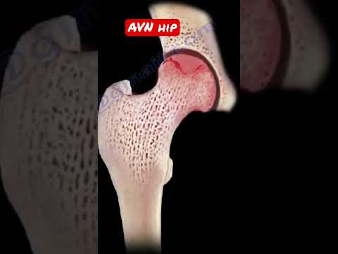 What is AVN of the hip? #shorts