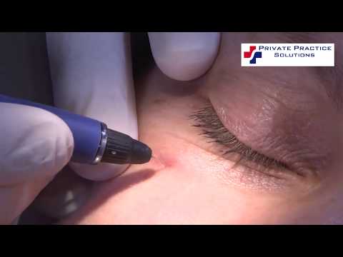 Most Popular Device for Rosacea Reduction - RF Device (EVRF)