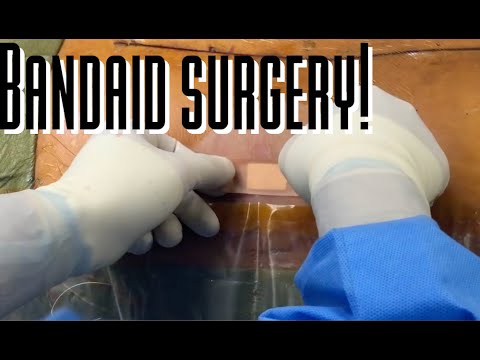 45 year old RN with L5-4 Foraminal Disc Herniation and L5-S1 Annular Tear Treated with LESS
