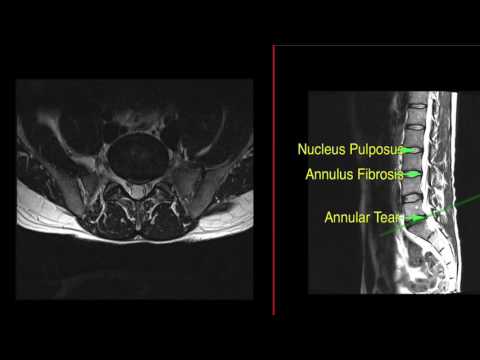 Annular tear in lumbar spine