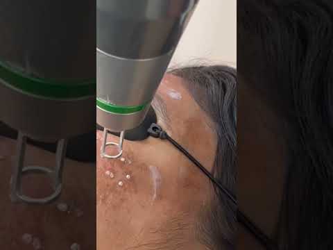 ND Yag Q switch laser for Melasma