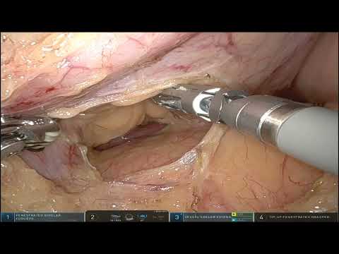 Duodenum Dissection (Separation) on a 98 BMI Patient