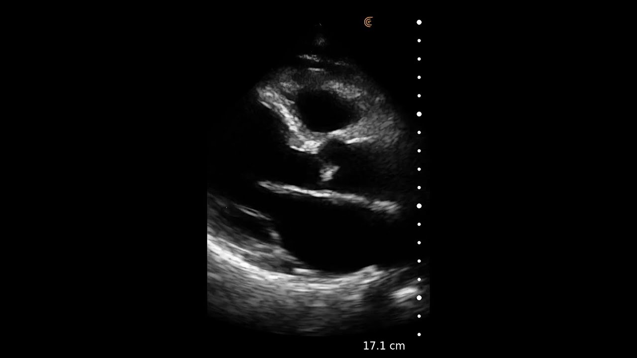 Congestive Heart Failure – Ultrasound Image Interpretation