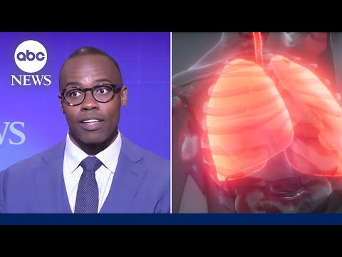 National Blood Clot Alliance: Someone dies of a blood clot in US every 6 minutes